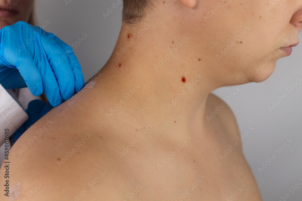 Стоковое фото «Close-up of the wound that remained after excision of ...