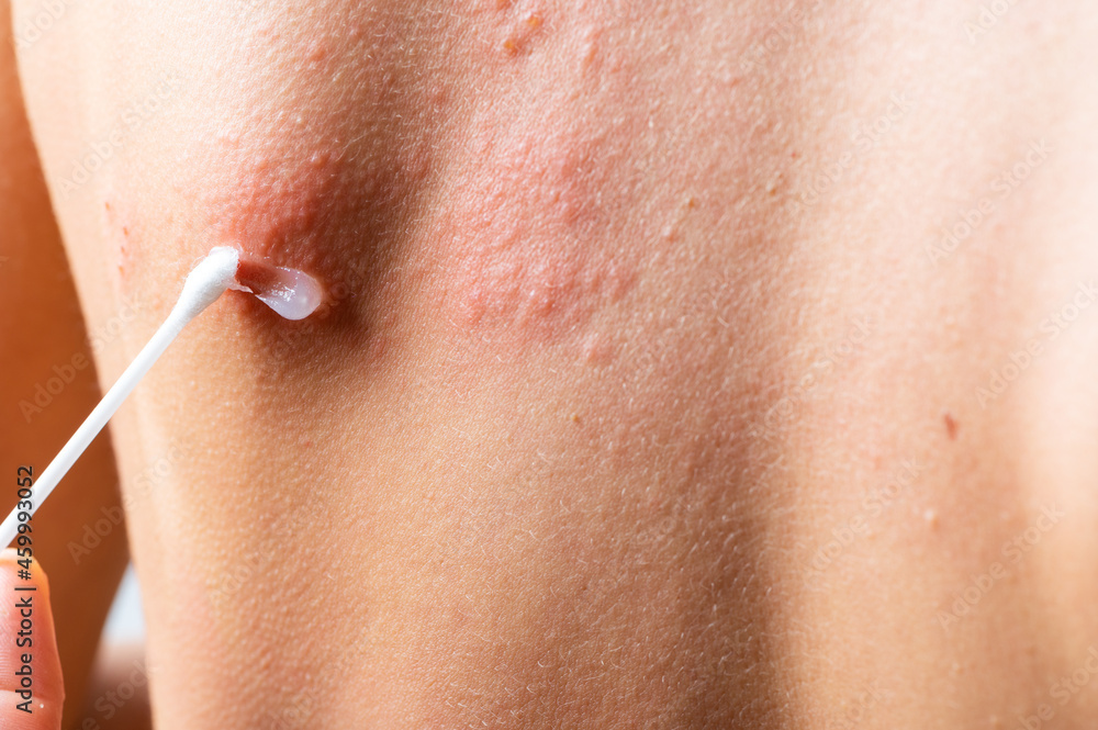 Photo Stock cotton swab treatment of skin rash. Shingles, varicella ...