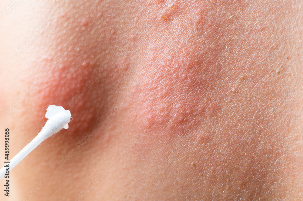cotton swab treatment of skin rash. Shingles, varicella-zoster virus ...
