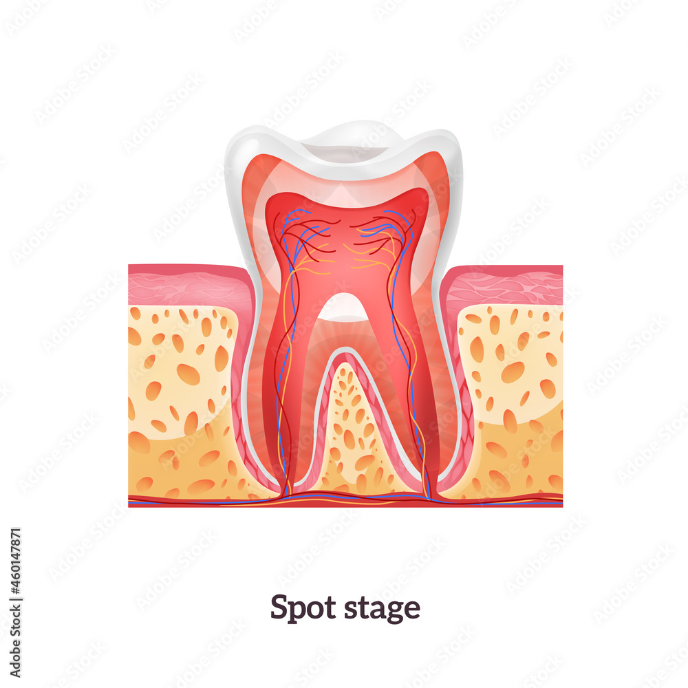 Realistic Caries Tooth Anatomy Stock Vector | Adobe Stock