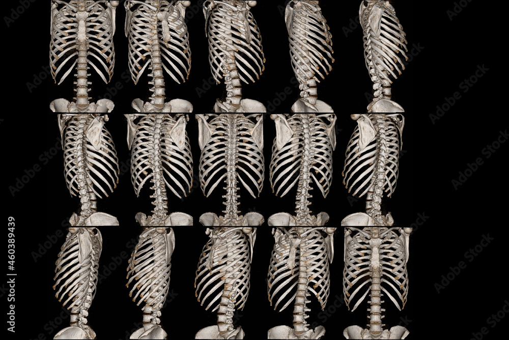 CT Scan thoracic spine 3D rendering image case trauma fracture thoracic ...