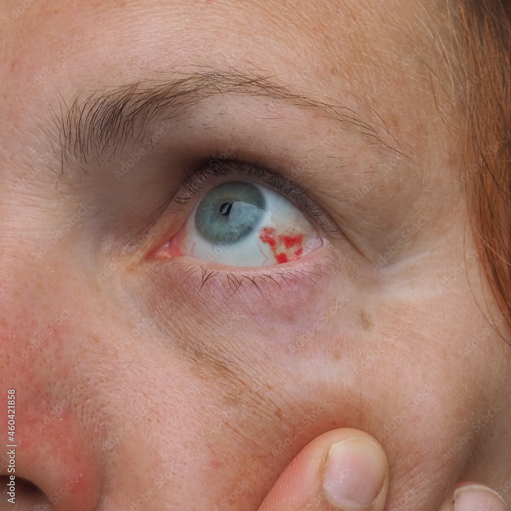 Subconjunctival hemorrhage or subconjunctival bleeding, hyposhagmus ...