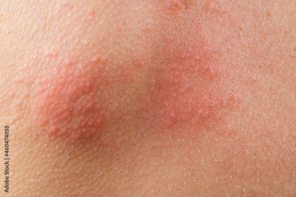 chickenpox rash. Shingles, varicella-zoster virus. skin rash and ...
