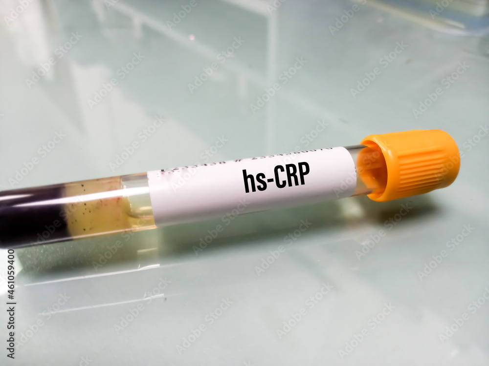 Blood sample tube for hs CRP(high-sensitivity C-reactive protein) test ...