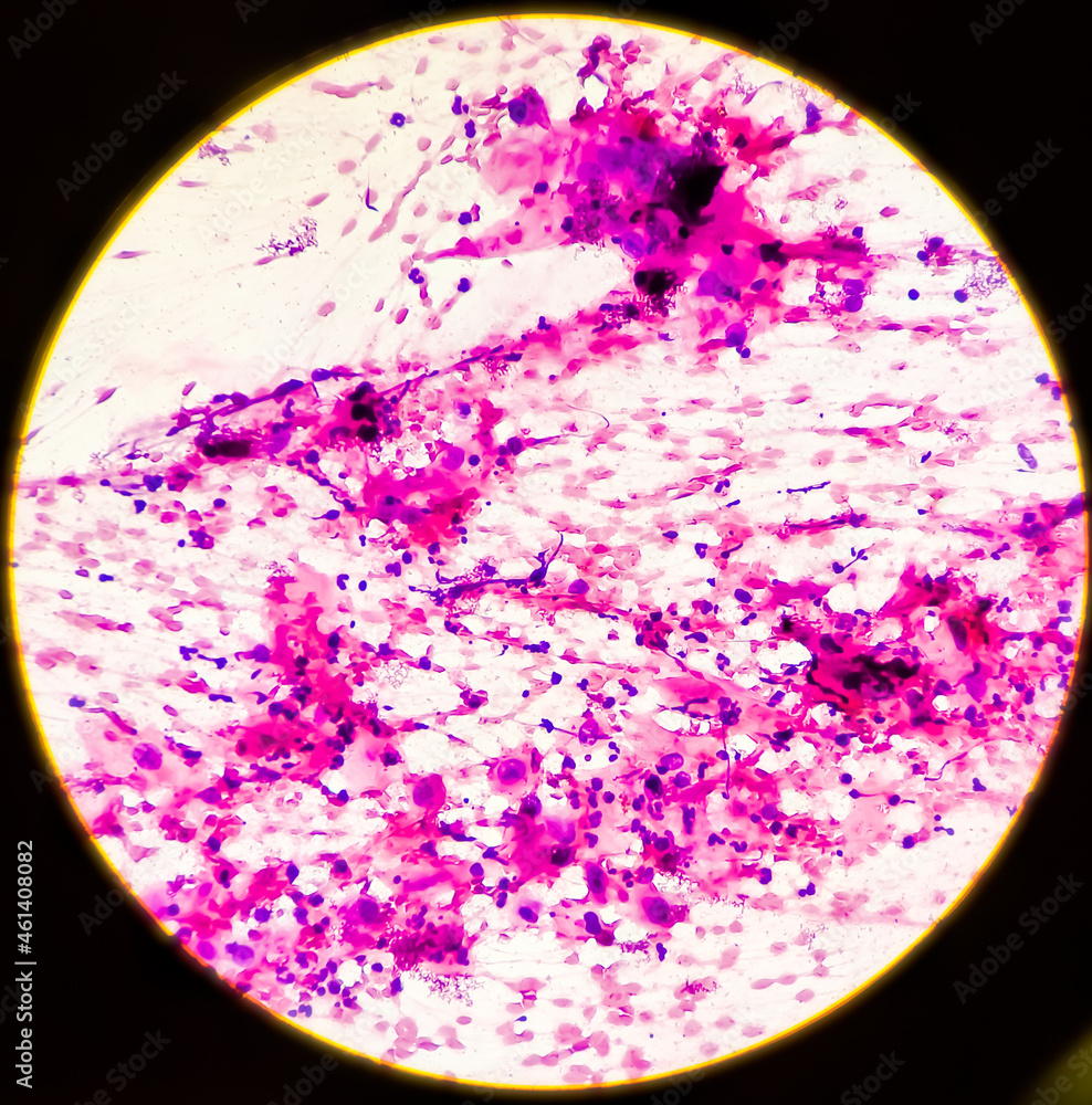 Microscopic view of Metastatic squamous cell carcinoma, atypical ...