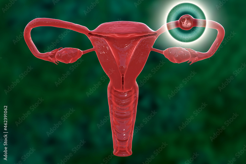 Tubal ectopic pregnancy, 3D illustration 素材庫插圖 | Adobe Stock
