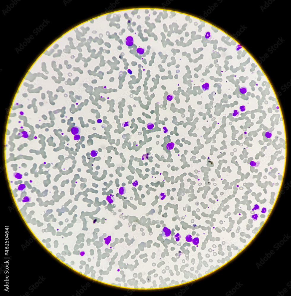 Leuco-erythroblastic anaemia and Chronic myelomonocytic leukemia (CMML ...