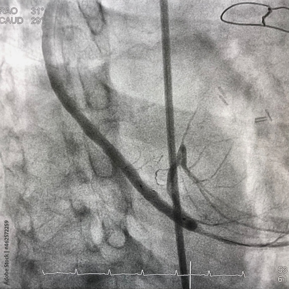 coronary angiogram showed saphenous vein graft (SVG) after Drug Eluting ...