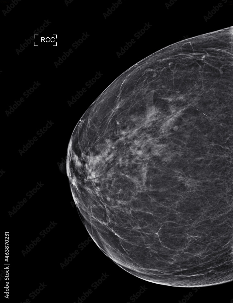 X-ray Digital Mammogram or mammography both side of the breast CC view ...