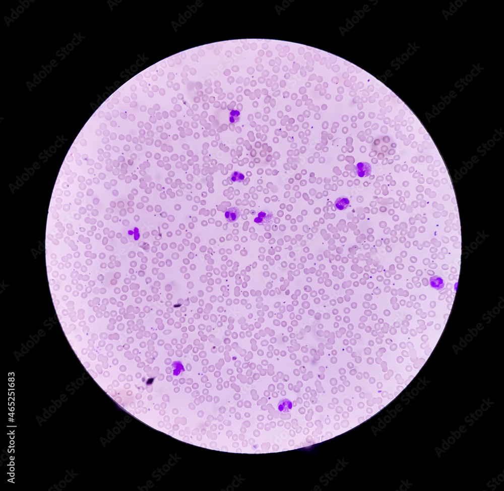 Blood smear Microscopic show increase number of Eosinophils a type of ...