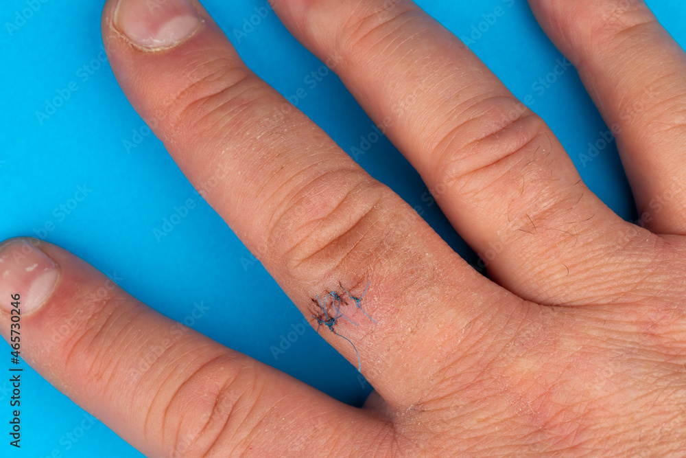 Postoperative sutures on the finger of the hand.. Stitches on the ...
