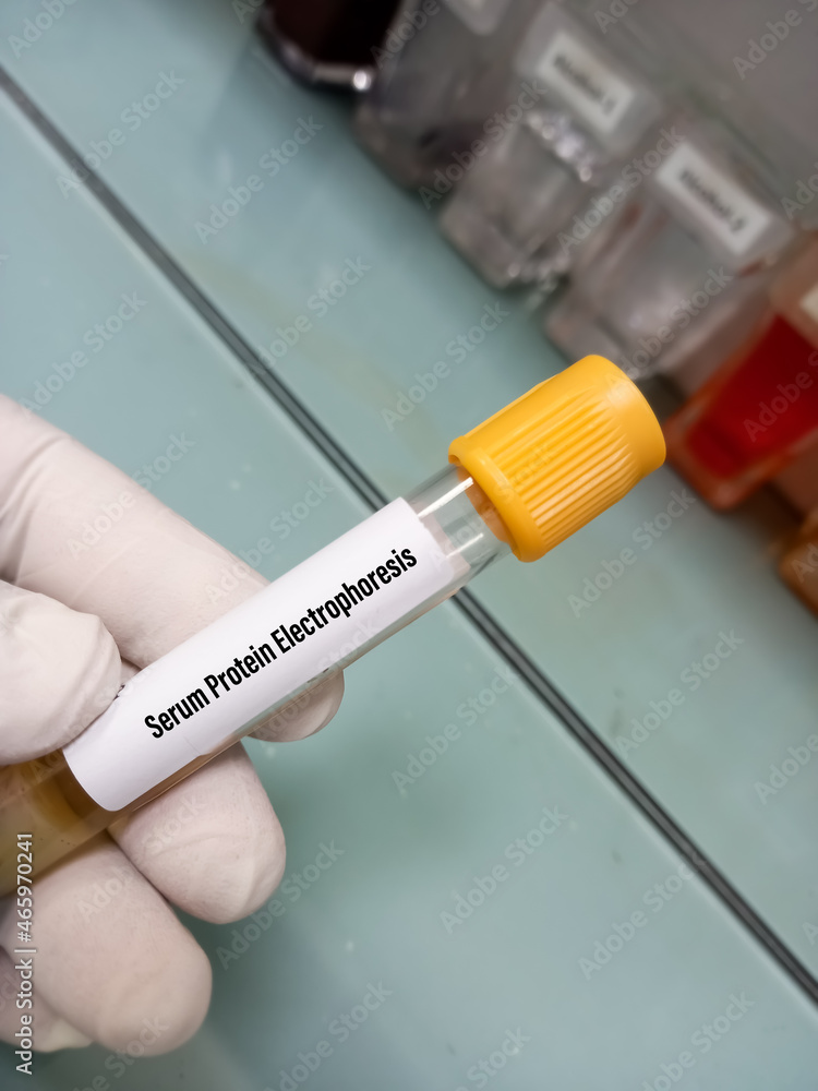 Blood sample for Serum Protein Electrophoresis(SPEP) test. medical ...