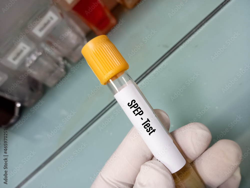 Blood sample for Serum SPEP(Serum Protein Electrophoresis) test ...