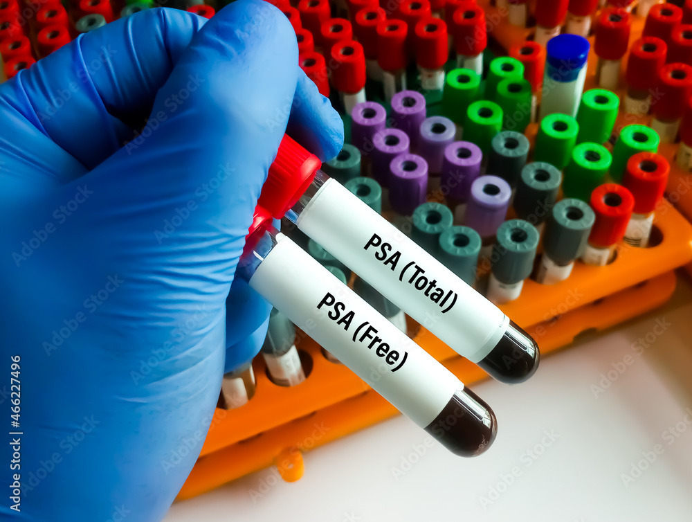 Biochemist hold test tubes with blood sample for PSA (Total and Free ...