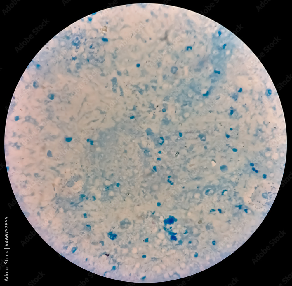 Stock-Foto „Sputum smear under microscopy showing gram positive cocci ...