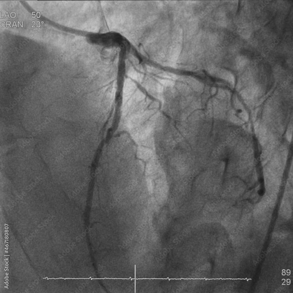 Coronary angiogram (CAG) was performed left anterior descending artery ...