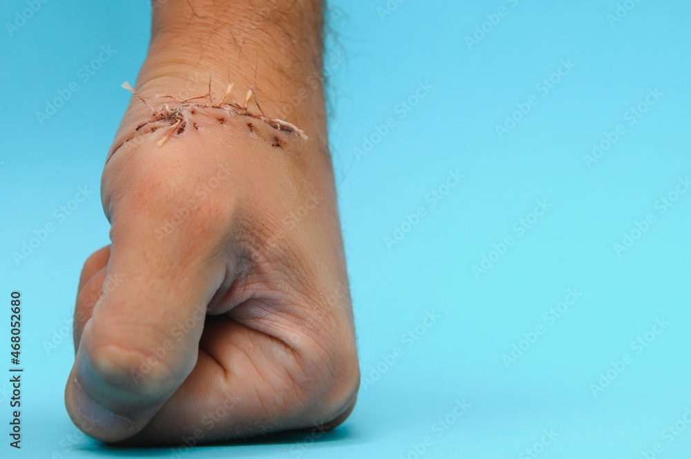 Suture wound on hand from dermatology procedure Stock Photo | Adobe Stock Suture wound on hand from dermatology procedure Stock Photo | Adobe Stock
