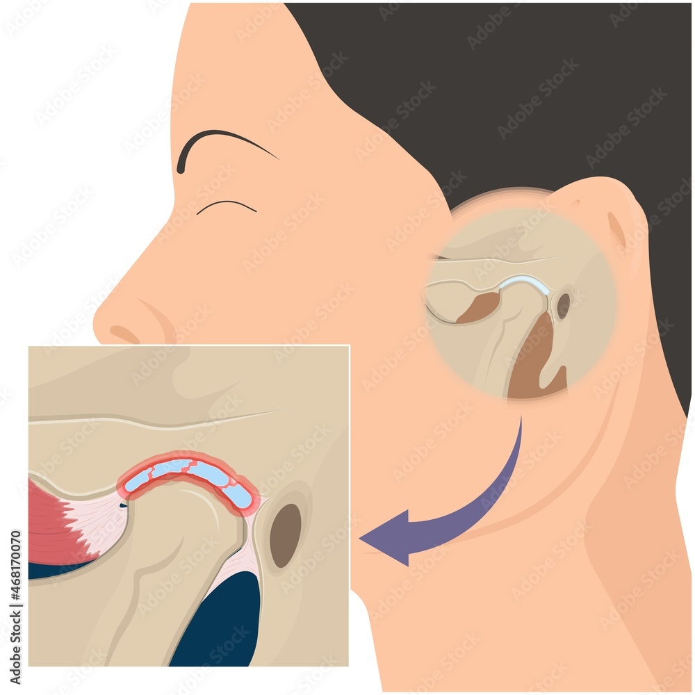 Vector de Stock Temporomandibular Joint Disorders TMD TMJ treat pain ...