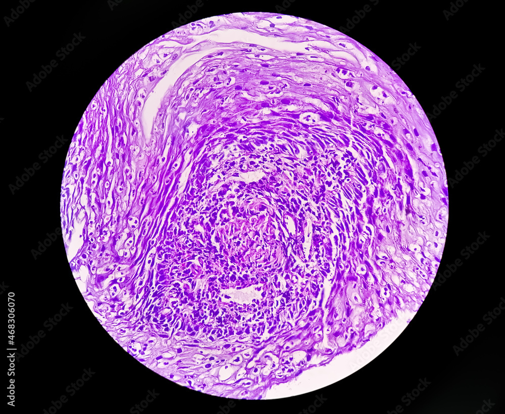 Adenocarcinoma of esophagus. Esophageal cancer or cancer of the food ...