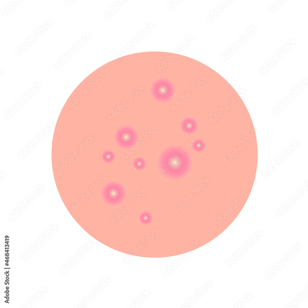 A round piece of skin with pimples. Inflammatory acne on the body ...