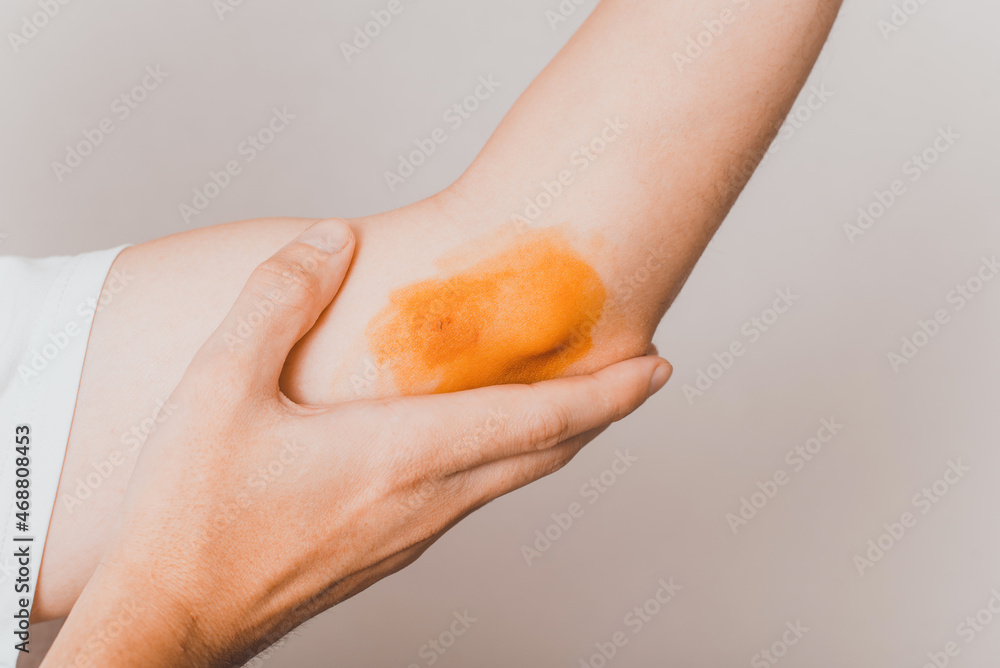 Human left hand elbow injury, close up. Unrecognizable person showing ...