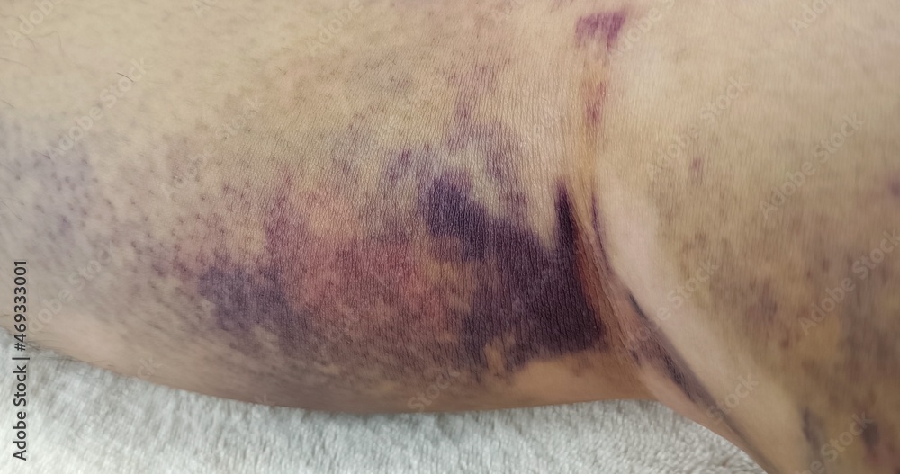 bruised skin on leg of patient, patient skin after knee surgery process ...