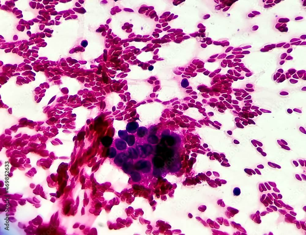 Hepatocellular Carcinoma Microscopic image of FNAC Fine Needle ...