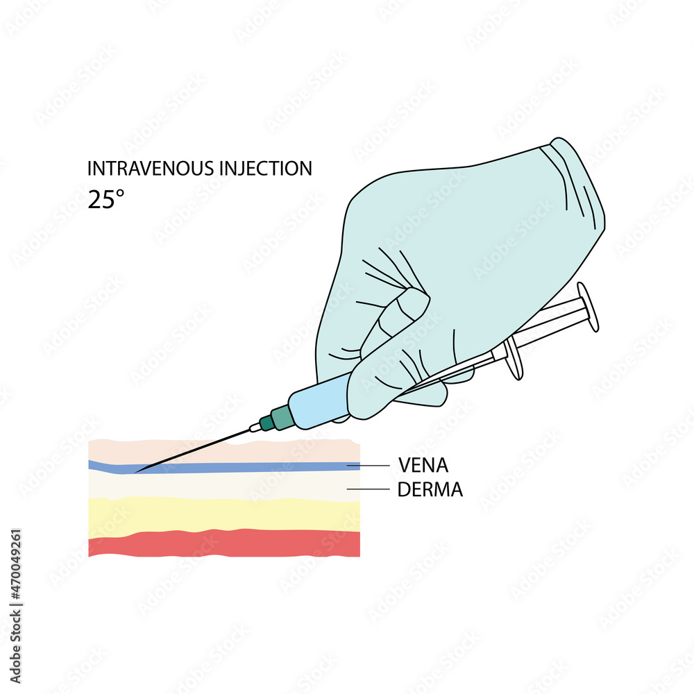 Intravenous injection. Effective methods of administration of drugs and ...