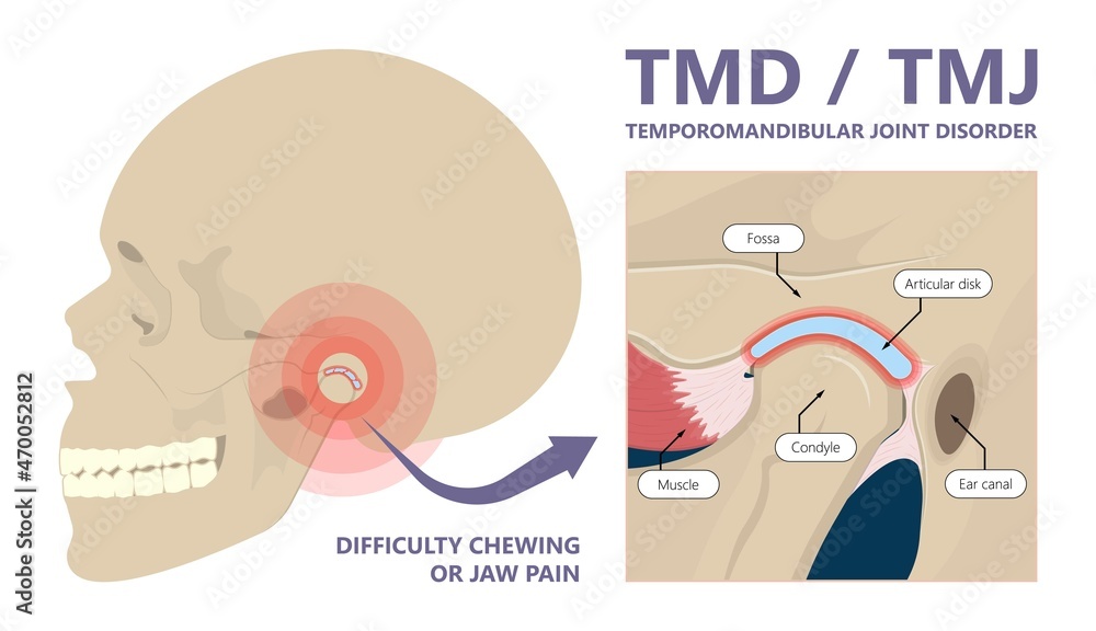 Temporomandibular Joint Disorders TMD TMJ treat pain displaced disc ...