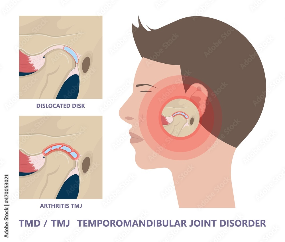 Temporomandibular Joint Disorders TMD TMJ treat pain displaced disc ...