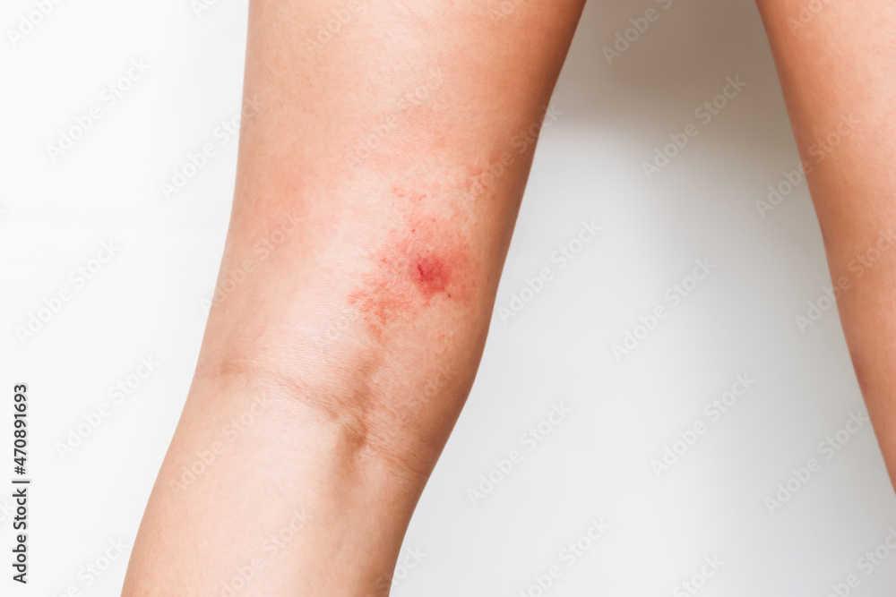 A red rash on the female thigh above the knee caused by an insect bite ...