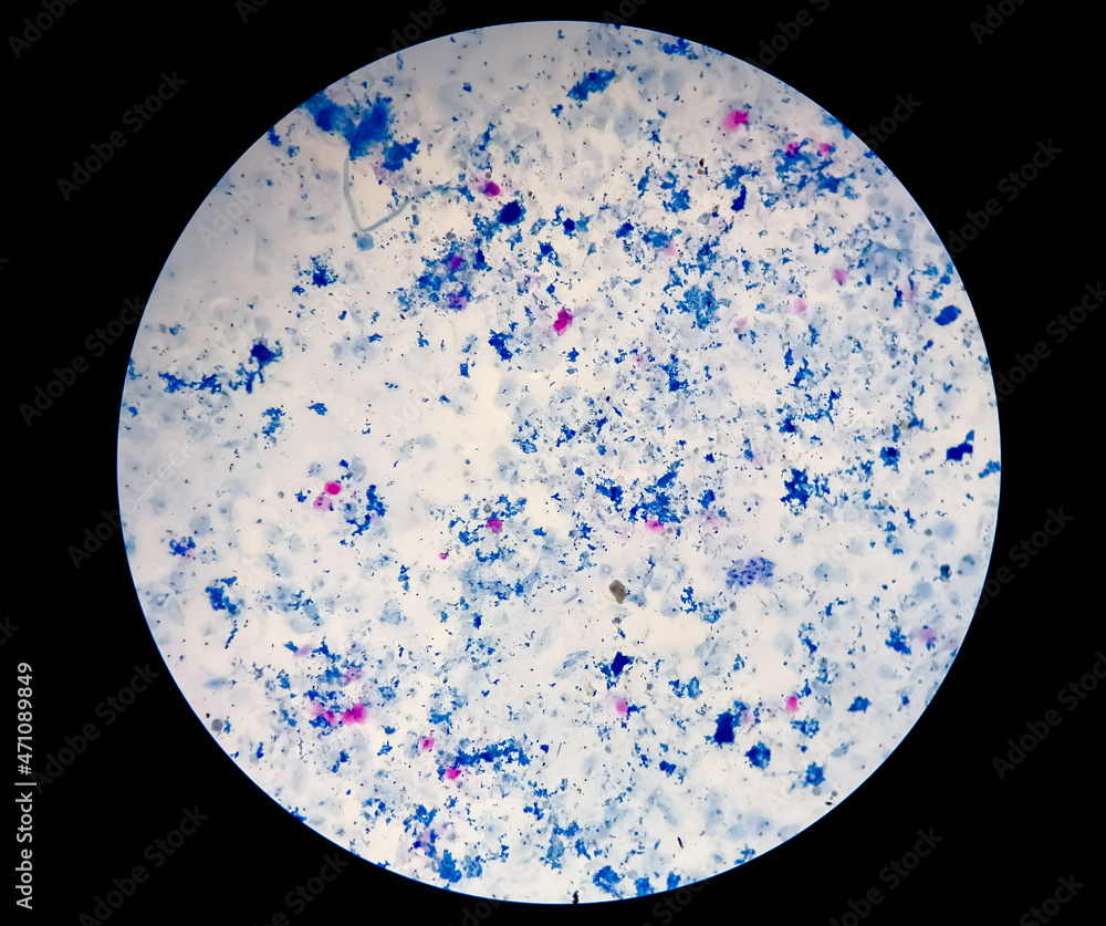 Sputum smear AFB stain microscopic close view. Macrobacterium ...
