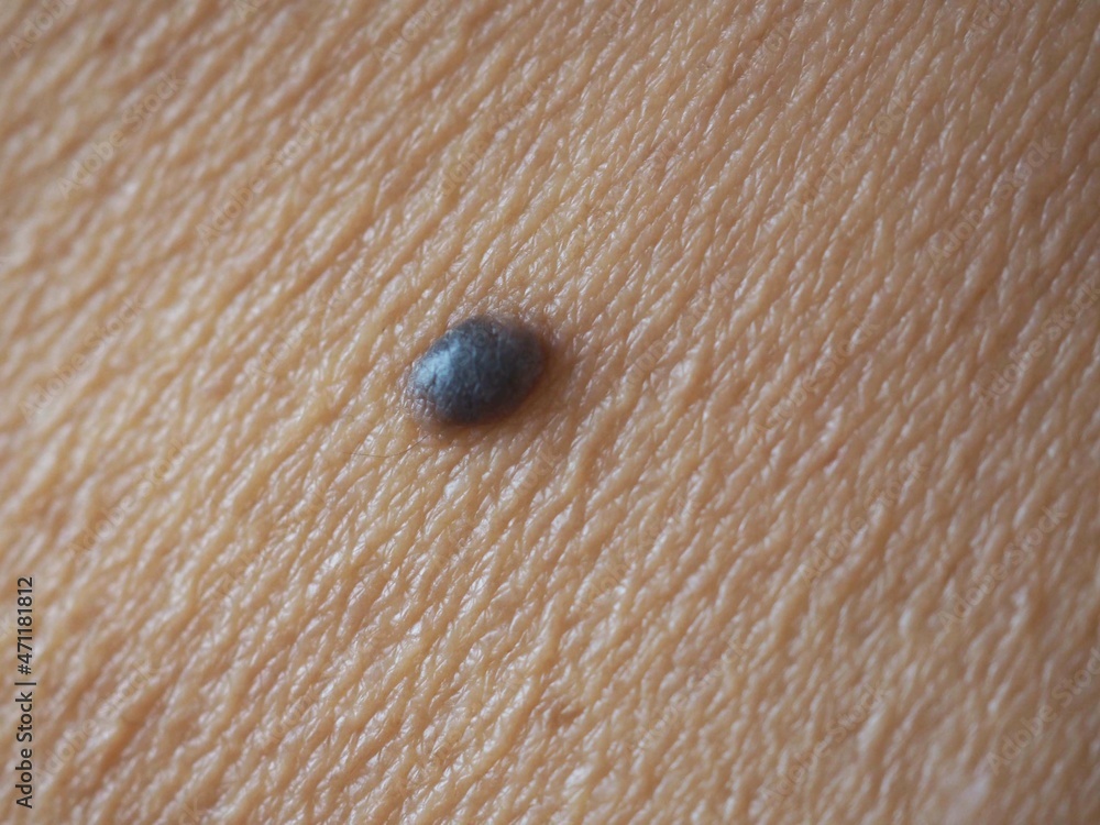 Mole or melanoma black color on abdomen woman of skin lesion case of ...
