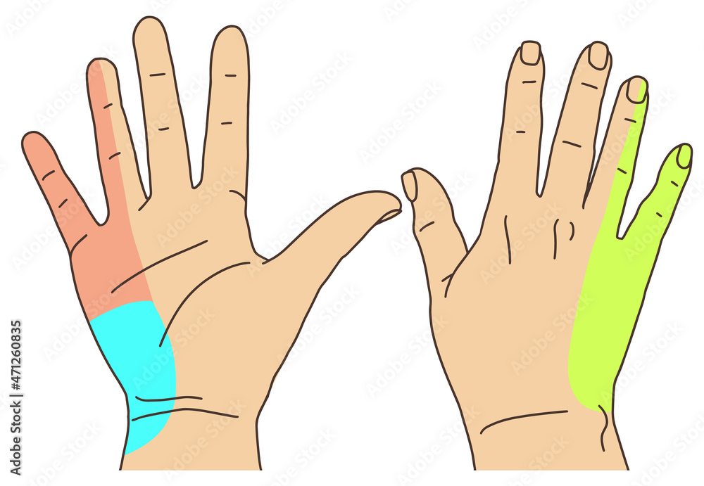 Scheme of numbness Tunnel syndrome of ulnar nerve. Doodle line drawing ...