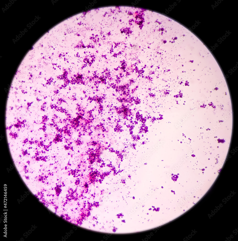 Foto de Stock Malignant cells(cancer cells): Pleural fluid cytology of ...