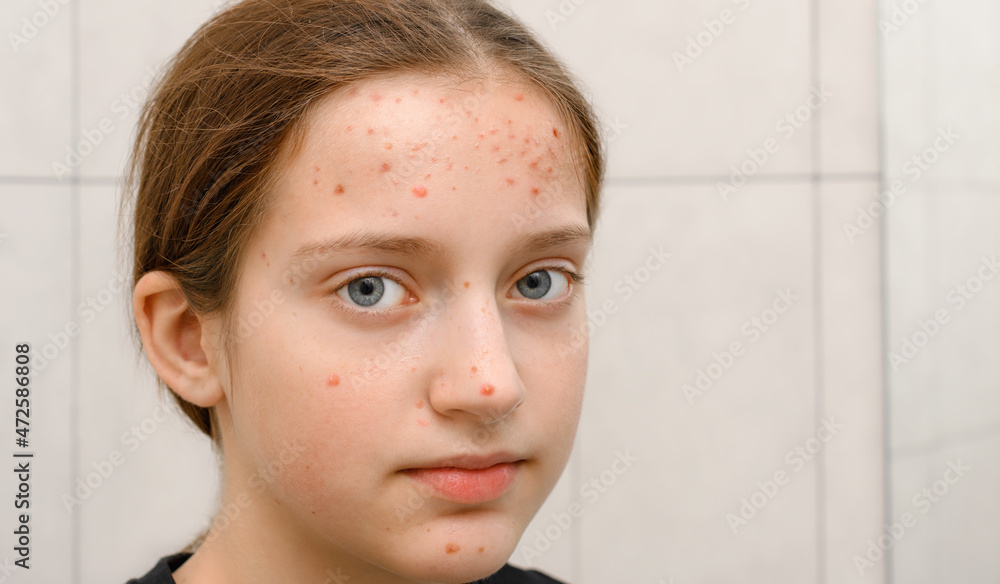 face of a teenage girl with pimples, acne on the skin, portrait of ...