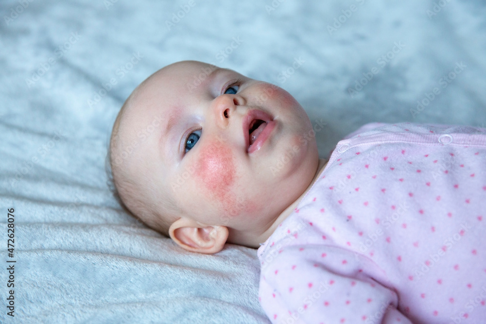 Newborn baby girl with red skin rash, dermatitics syndrom Stock Photo ...