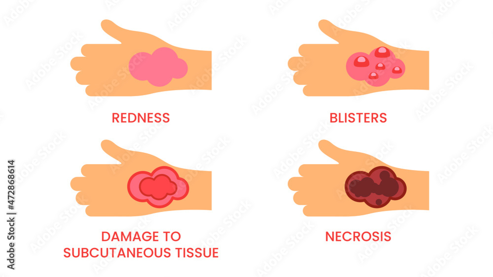 Abstract Flat Doctor Help Types Of Burns First Aid Cartoon People ...