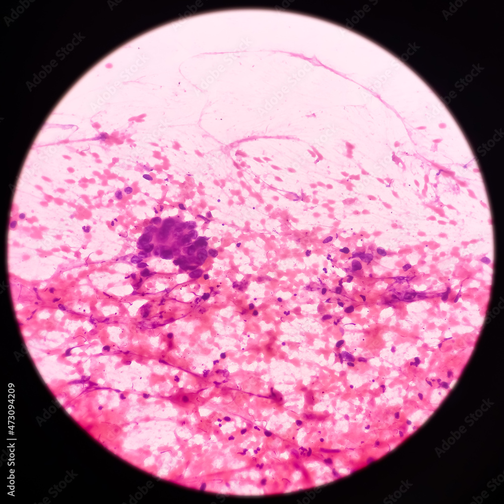 Squamous cell carcinoma of lung, malignant cells, sample aspirate from ...