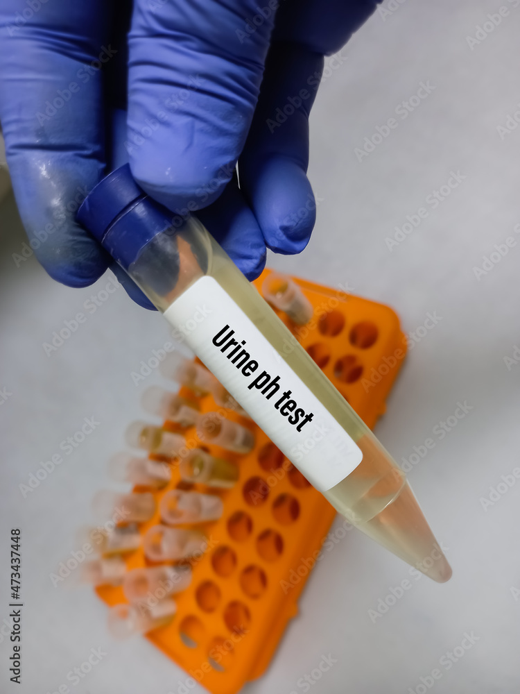 Urine sample container with sample for Urine pH test, monitoring the ...