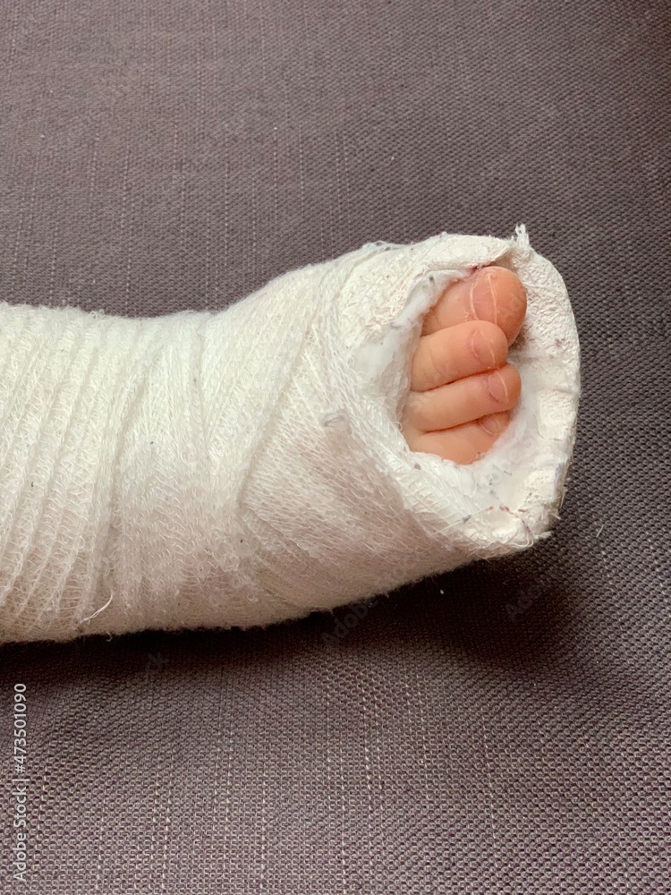 baby broken leg in a cast, childhood trauma, bone fracture, injury ...