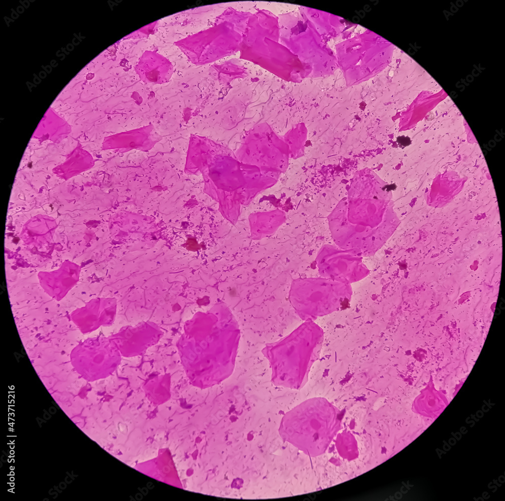 High Vaginal Swab (HVS) gram stain microscopic 40x show few pus cells ...