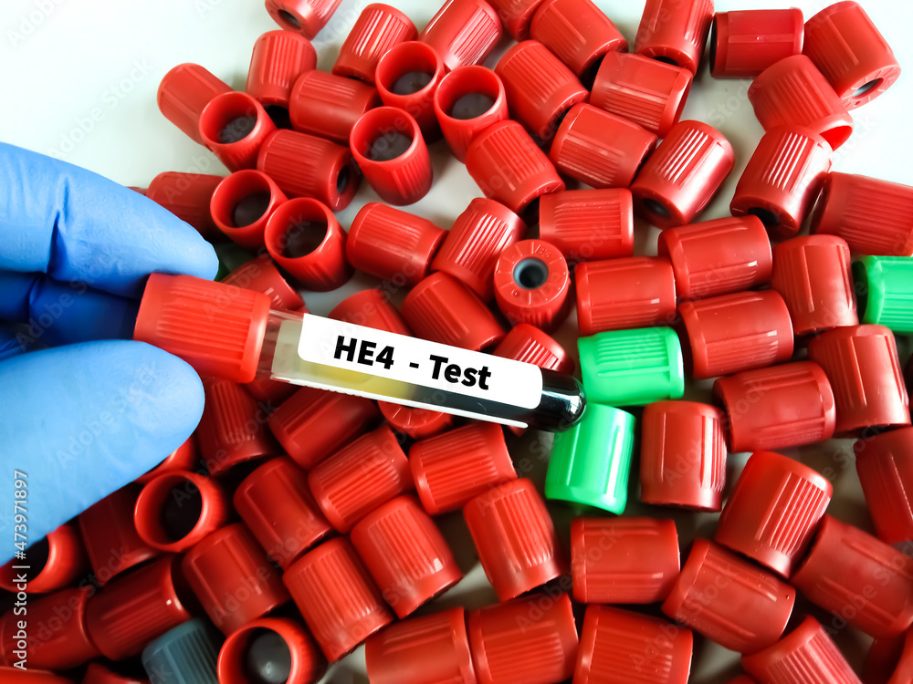 Blood sample for HE4 (human epididymis protein 4 ) test, monitoring ...