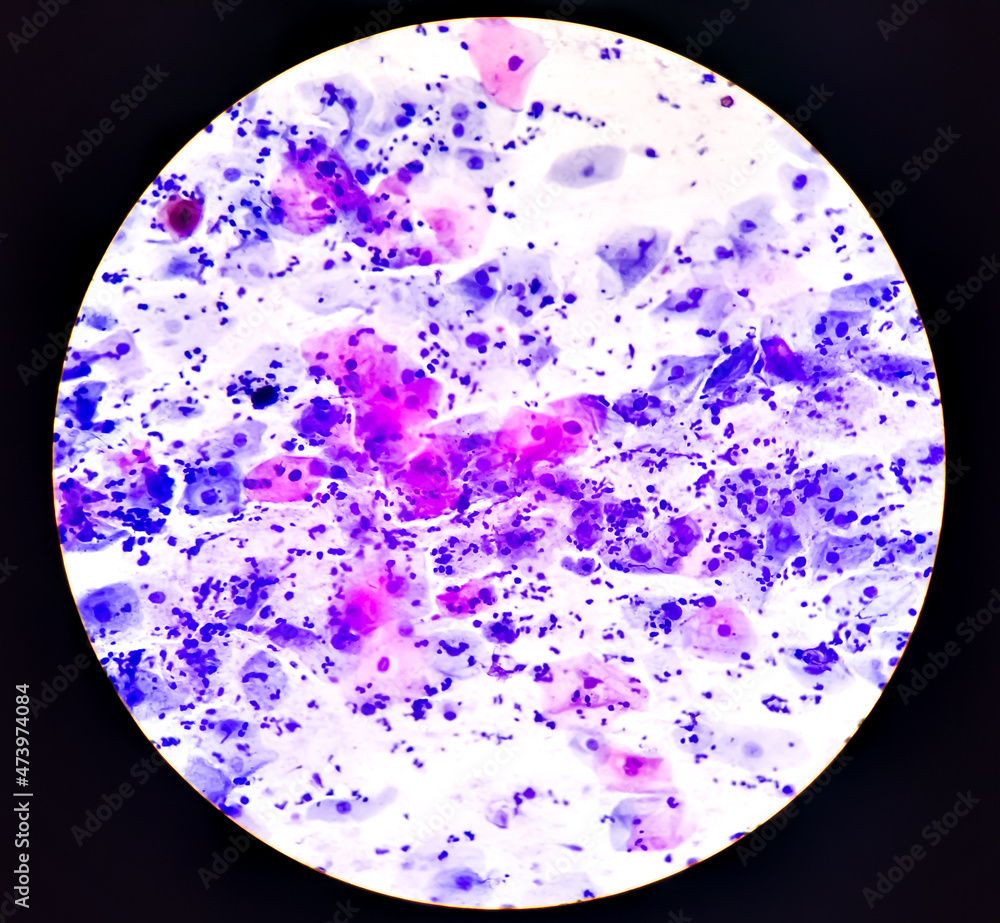 Cervical cancer cells. Atypical glandular cells, Adenocarcinoma of ...