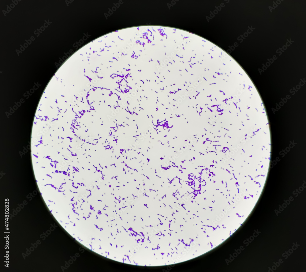 Streptococcus pyogenes infected in aged patient, showing of gram's ...