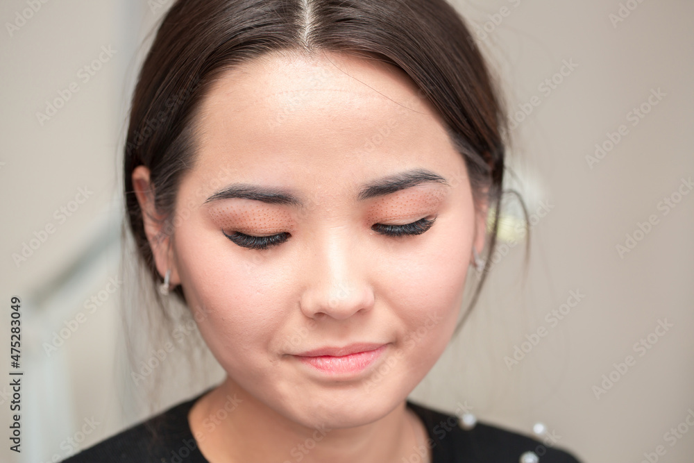 Cosmetic procedure for lifting the skin of the eyelids of Asian eyes ...