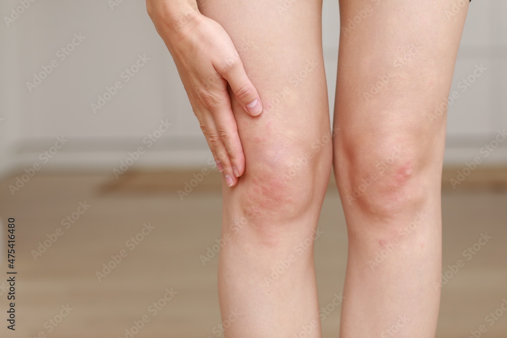 skin allergies, legs skin women. Closeup of red pustules on a knee, an ...