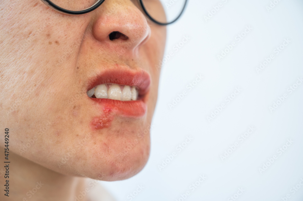 Herpes labialis occur on woman lower lip isolated on white background ...