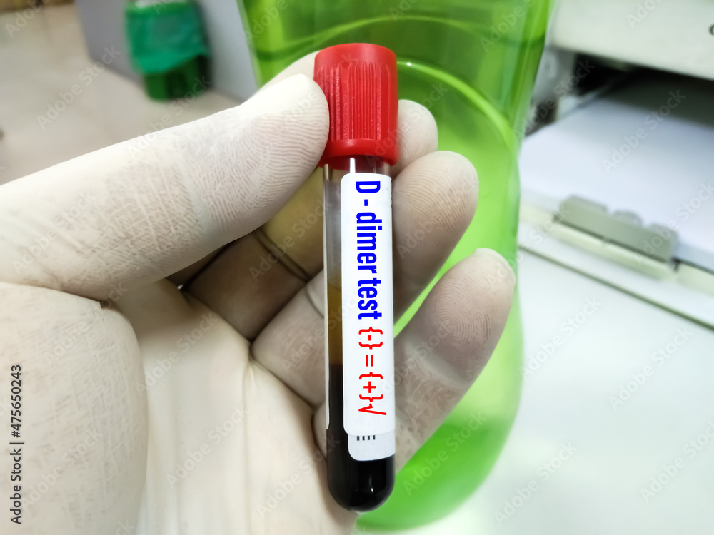 Test tube with positive blood sample for D-dimer test, diagnosis for ...