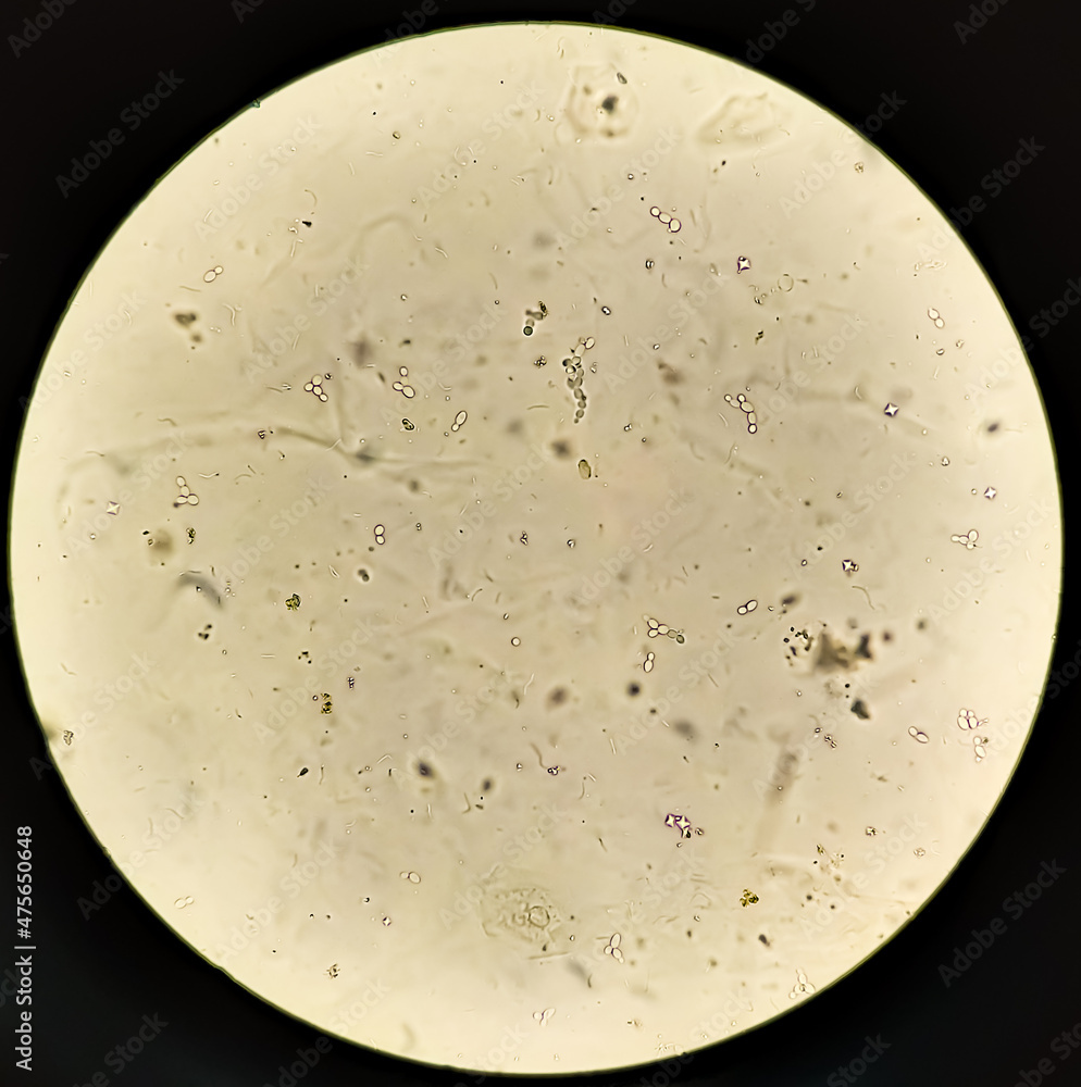 Sperm morphology. Semen photo under microscope. Micrograph showing ...
